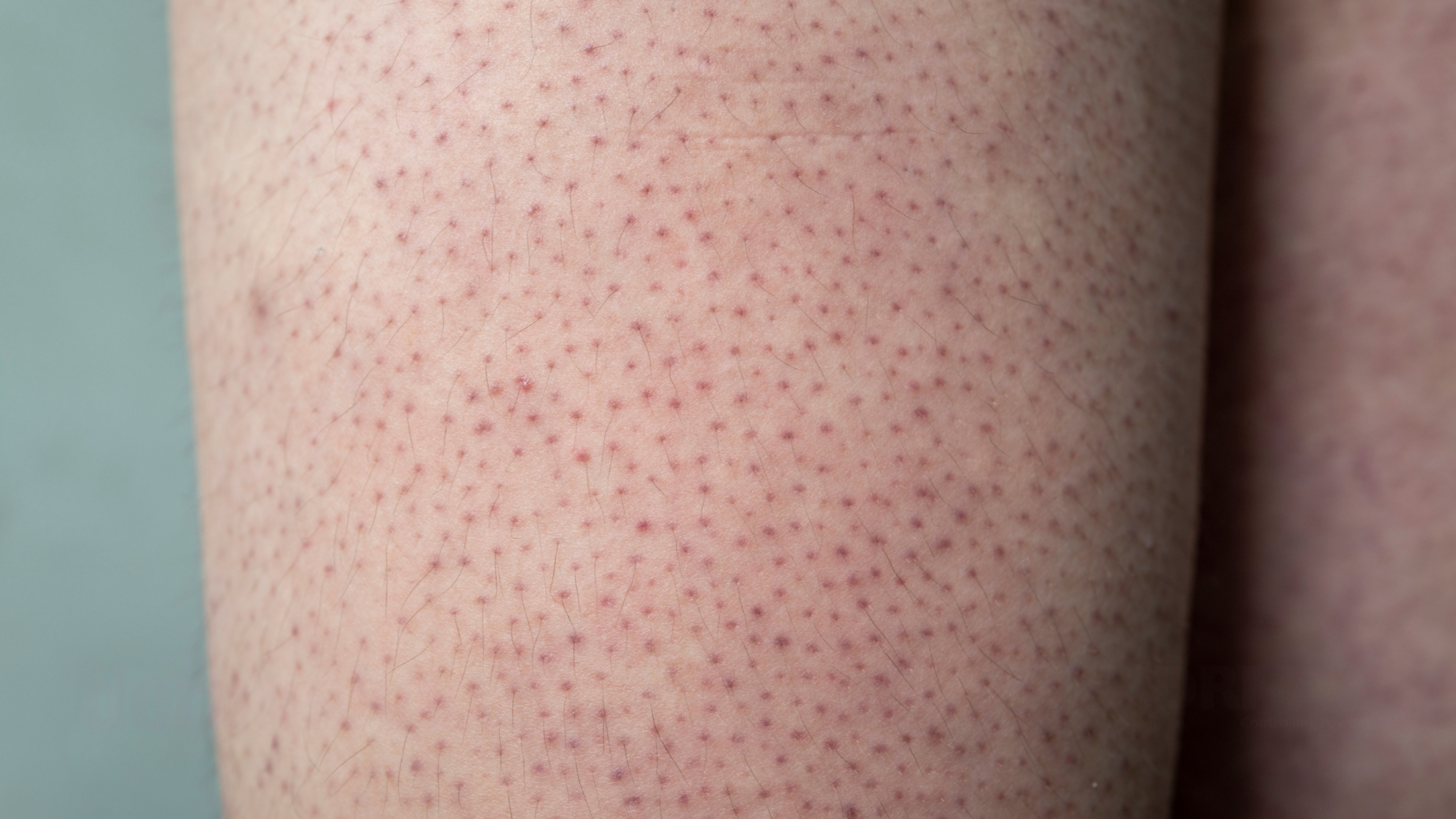 Bumpy Skin Breakthrough: Unexpected Help for Keratosis Pilaris – Dermelive